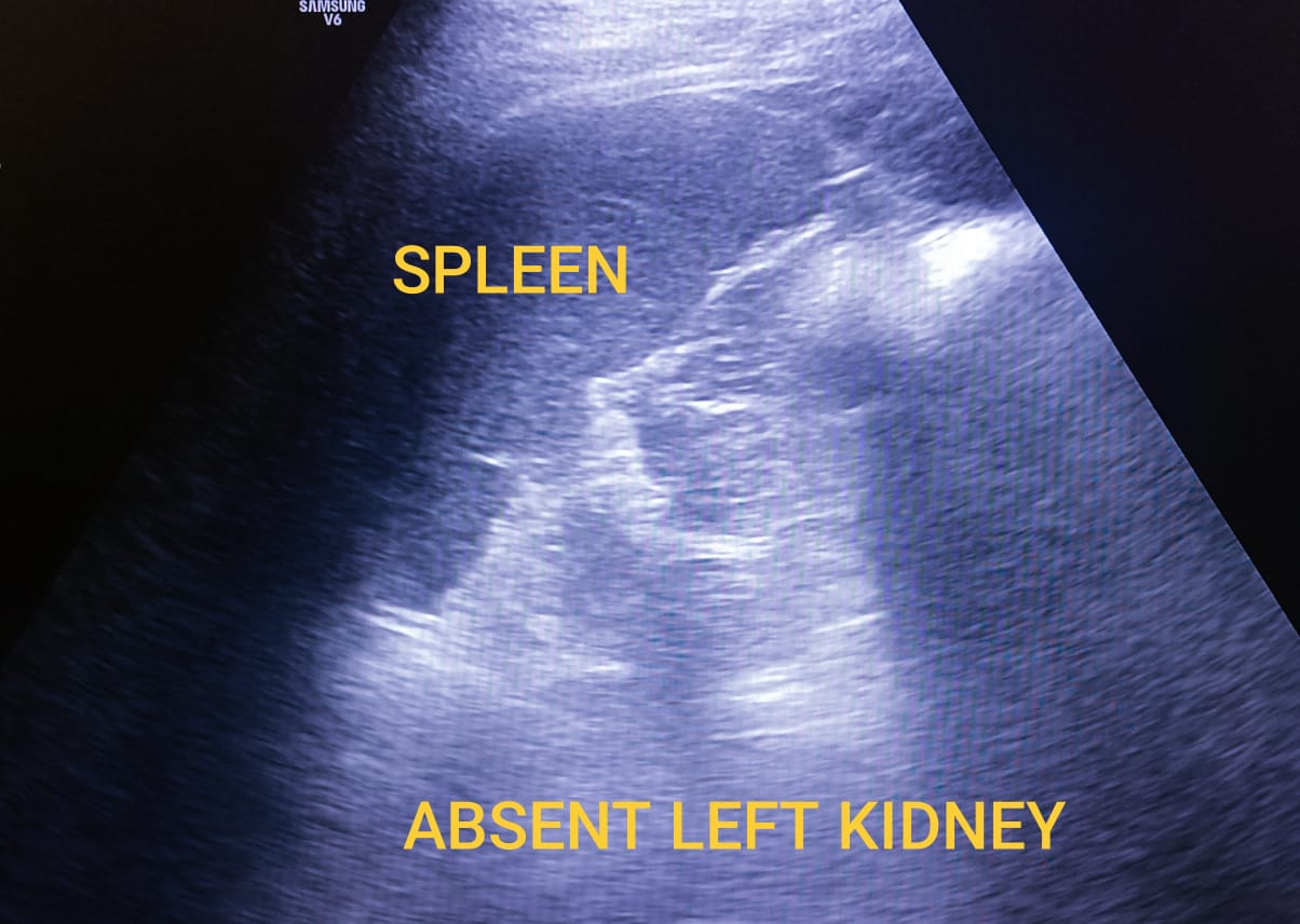 HOW COMMON IS ABSENT KIDNEY - ARDISS Imaging